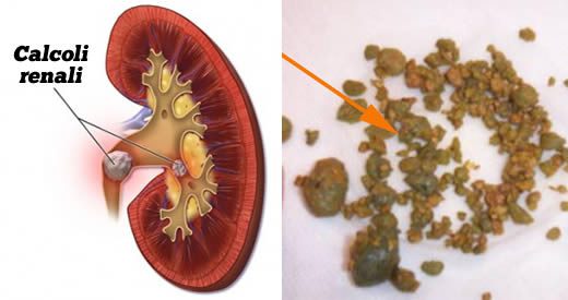 Calcoli Renali, Renella e Metabolismo del Fosforo – Erboristeria ...